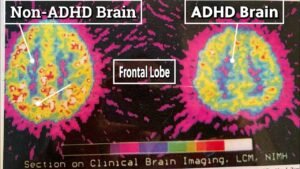 ADHD Brain Vs Normal Brain : Function, differences, and more - Adhd ...